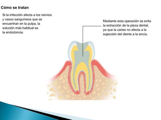 C:\fakepath\caries | PPT