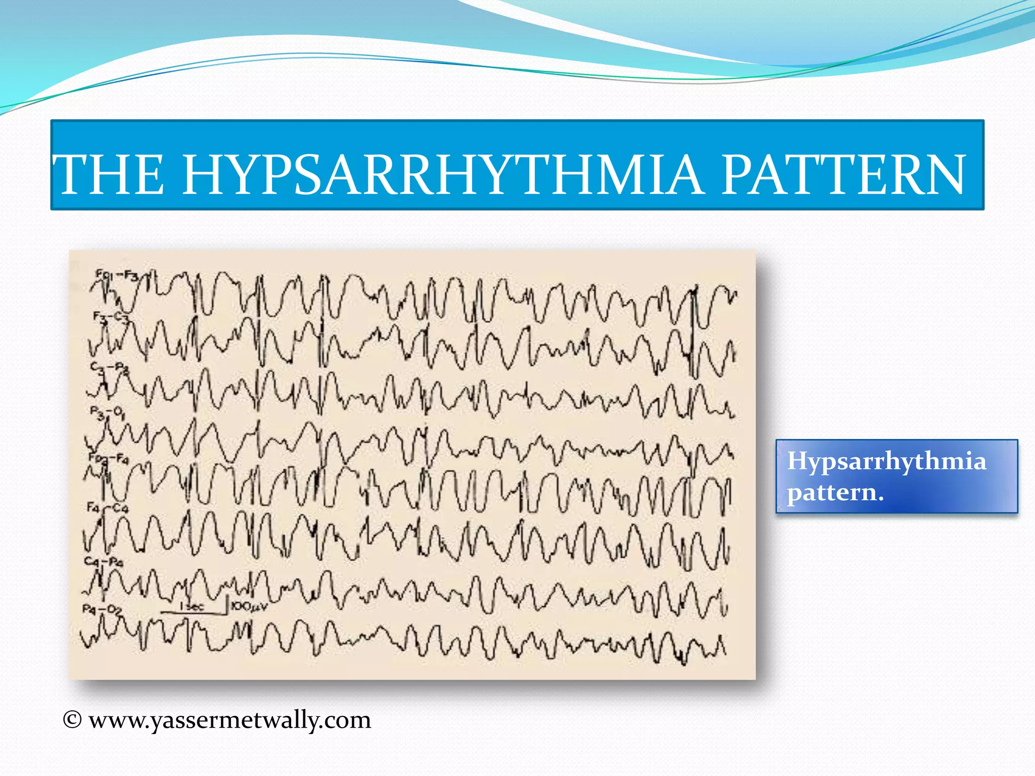 Issues In Brainmapping The Secrets Of Conventional Eeg Pptx Brain And Nervous System