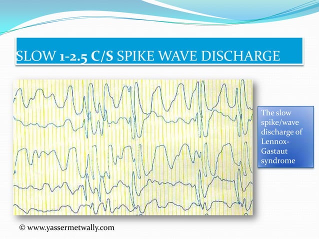 Issues in brainmapping...The secrets of conventional EEG | PPTX | Brain ...