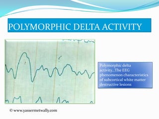 Issues in brainmapping...The secrets of conventional EEG | PPTX
