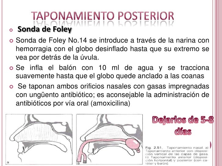 Epistaxis y taponamiento nasal