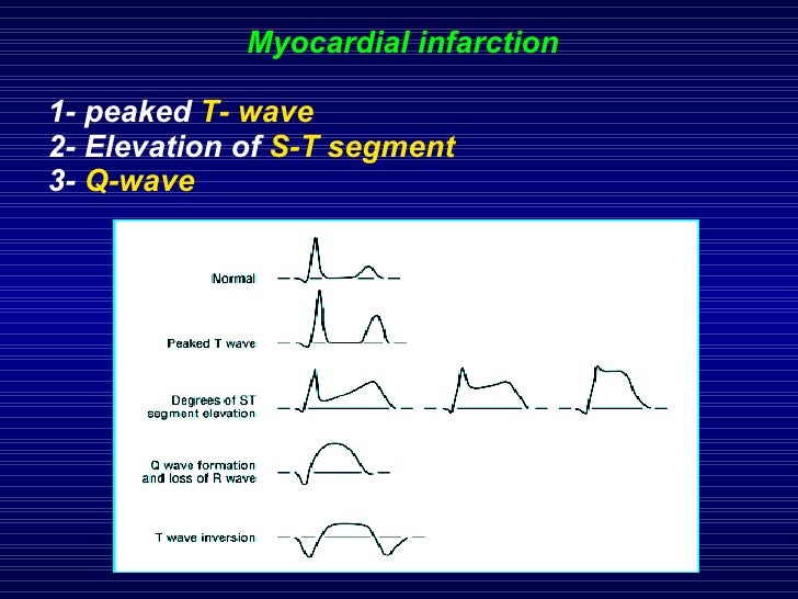 Essentials Of Ecg
