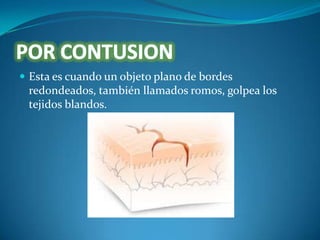 heridas | PPTX