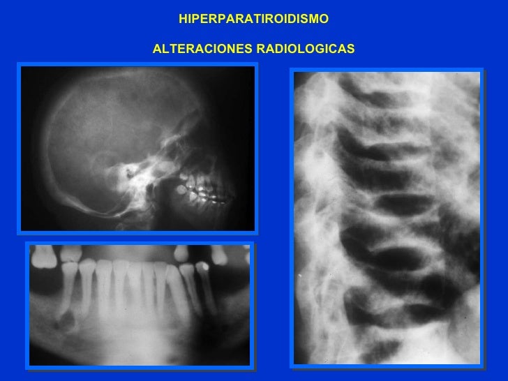 Hiperparatiroidismo