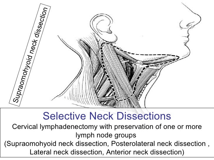 C:Neck Dissection
