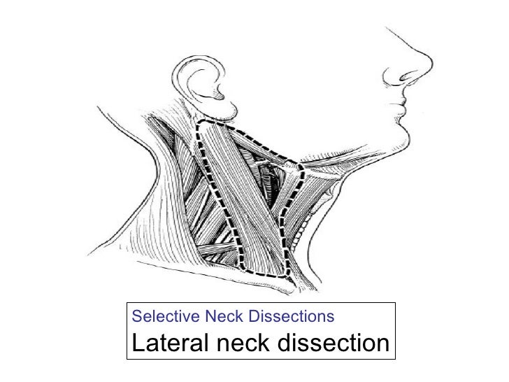 C:Neck Dissection