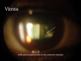 Overview of uveitis - Part2 Clinical features | PPTX