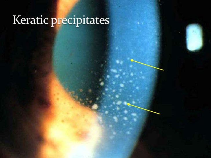 Overview of uveitis - Part2 Clinical features