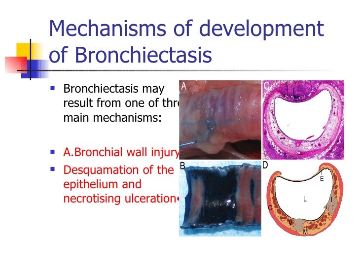 PATHOGENESIS OF BRONCHIECTASIS BY DR BASHIR AHMED DAR ASSOCIATE PROFE…