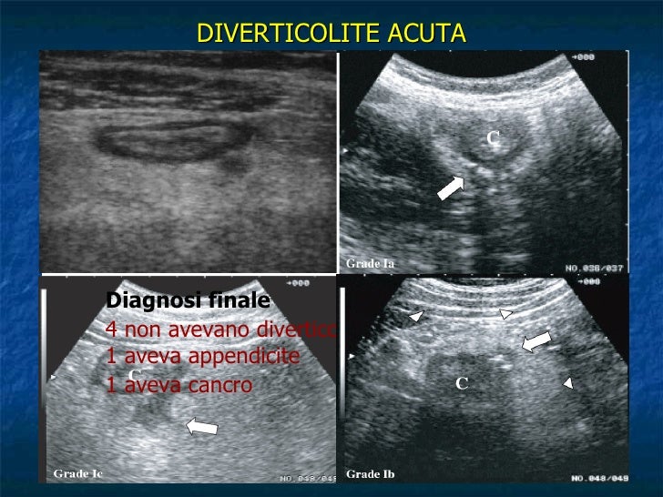 A.Zullo. Diverticuar disease Part 1. ASMaD 2009