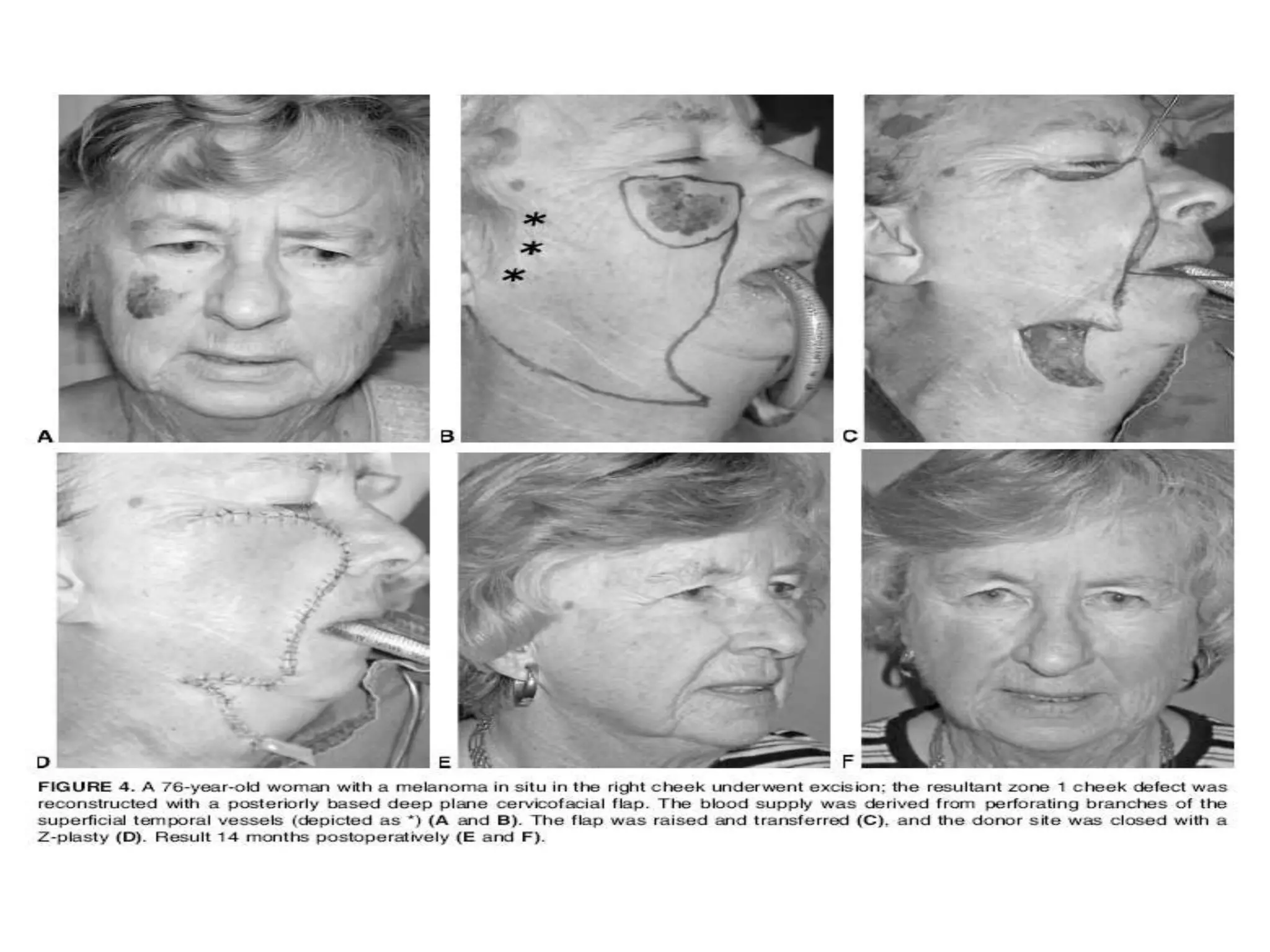 Cervicofacial flap : revisted | PPTX