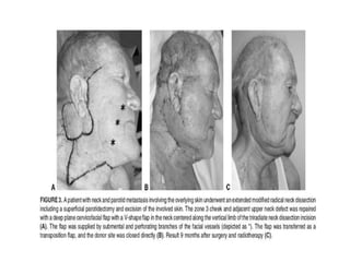 Cervicofacial flap : revisted | PPTX