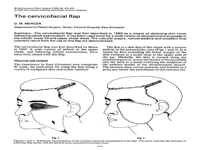 Cervicofacial flap : revisted | PPTX | Ear, Nose and Throat Conditions ...