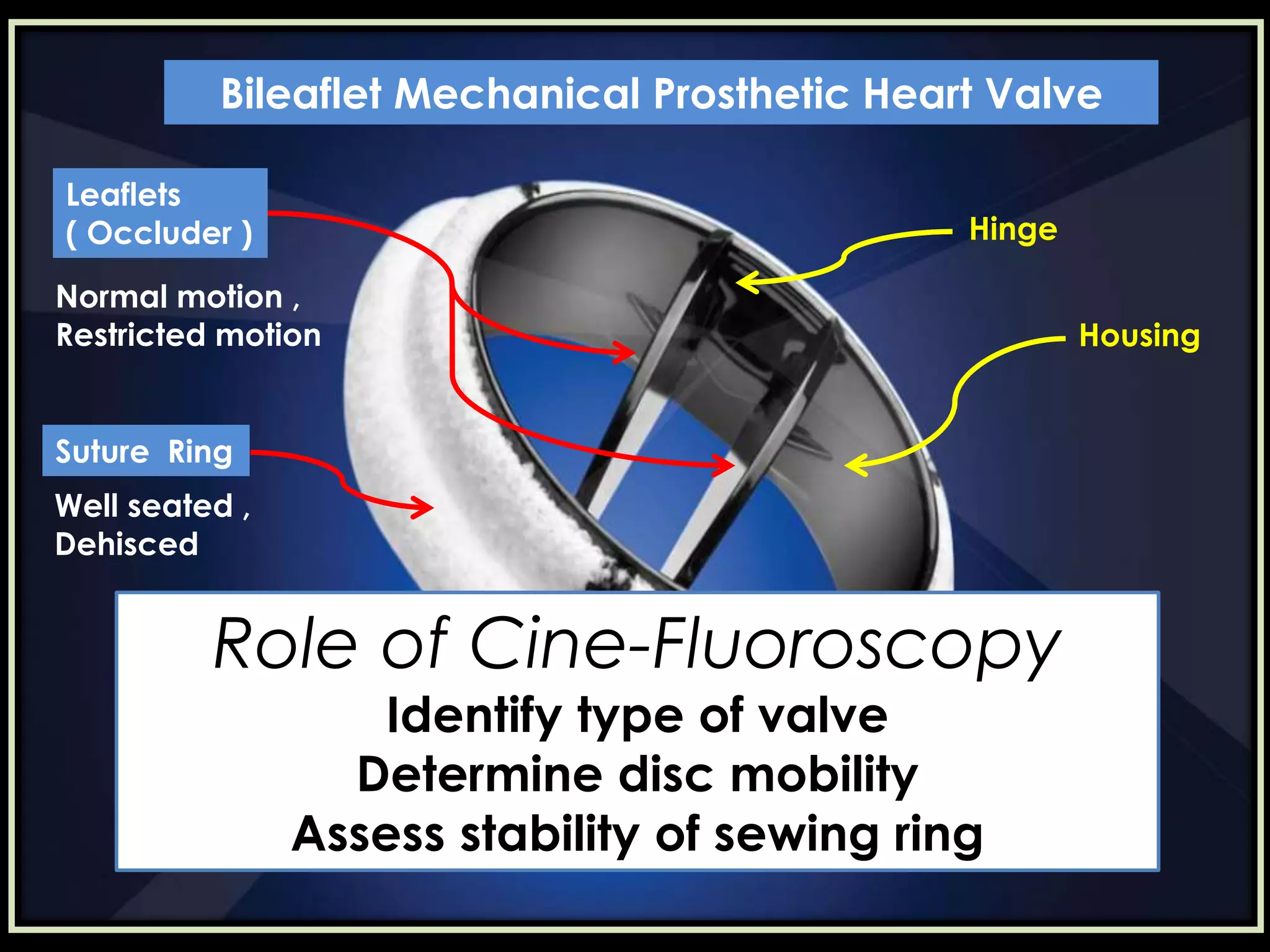 Role of cinefluoroscopy in prosthetic valve disease | PPTX