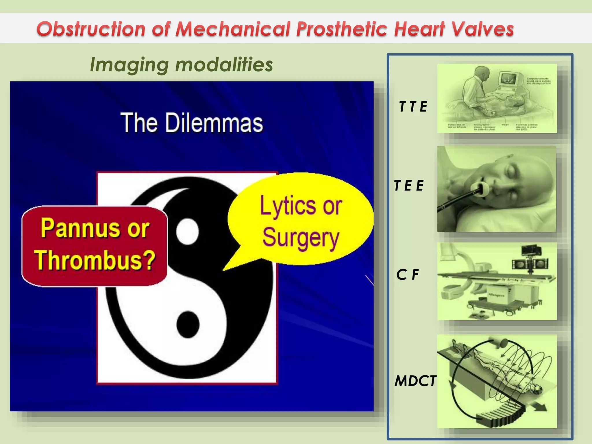 Role of cinefluoroscopy in prosthetic valve disease | PPTX