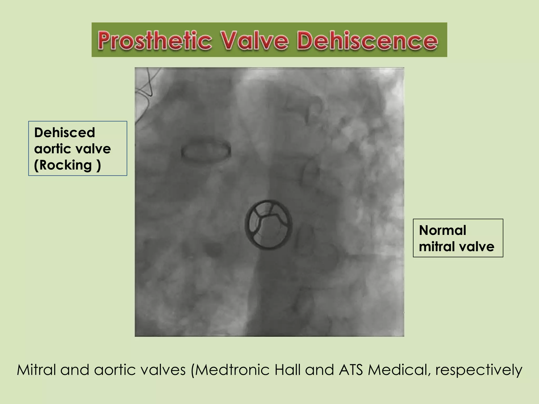 Role of cinefluoroscopy in prosthetic valve disease | PPTX