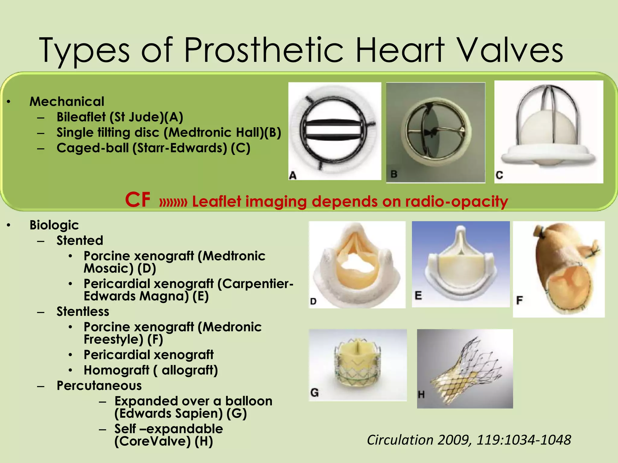 Role of cinefluoroscopy in prosthetic valve disease | PPTX