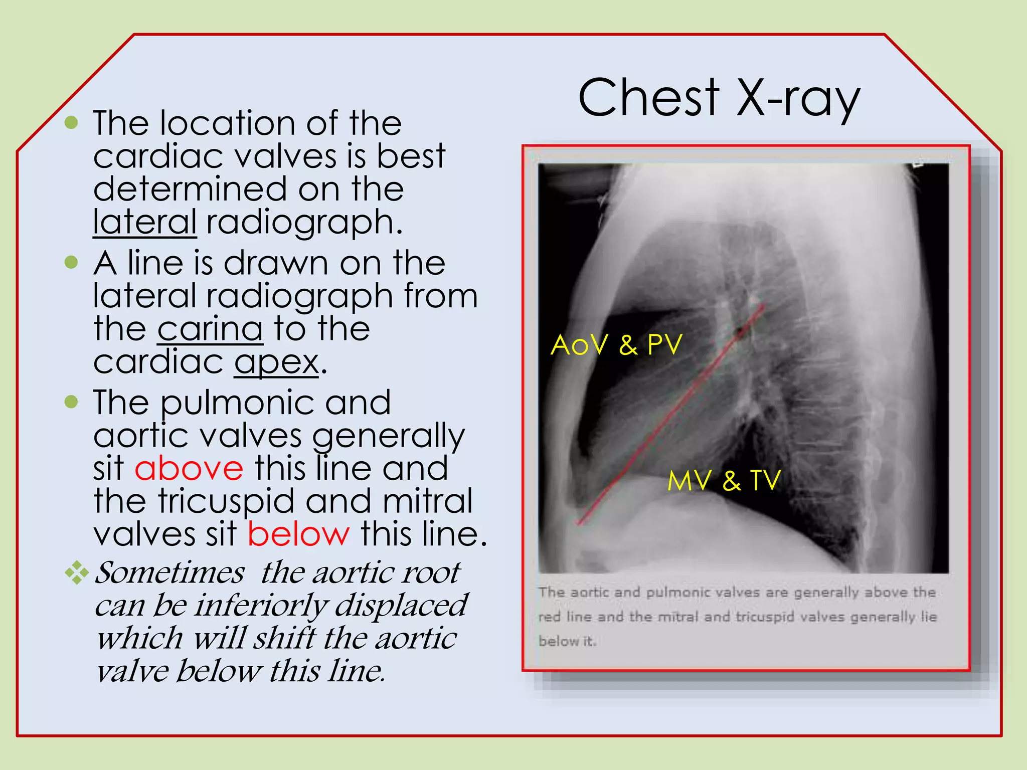 Role of cinefluoroscopy in prosthetic valve disease | PPTX