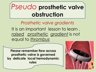 Role of cinefluoroscopy in prosthetic valve disease | PPTX