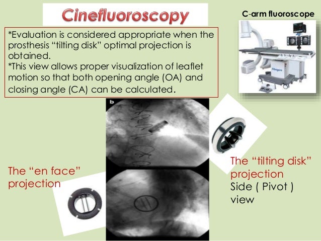 Role of cinefluoroscopy in prosthetic valve disease