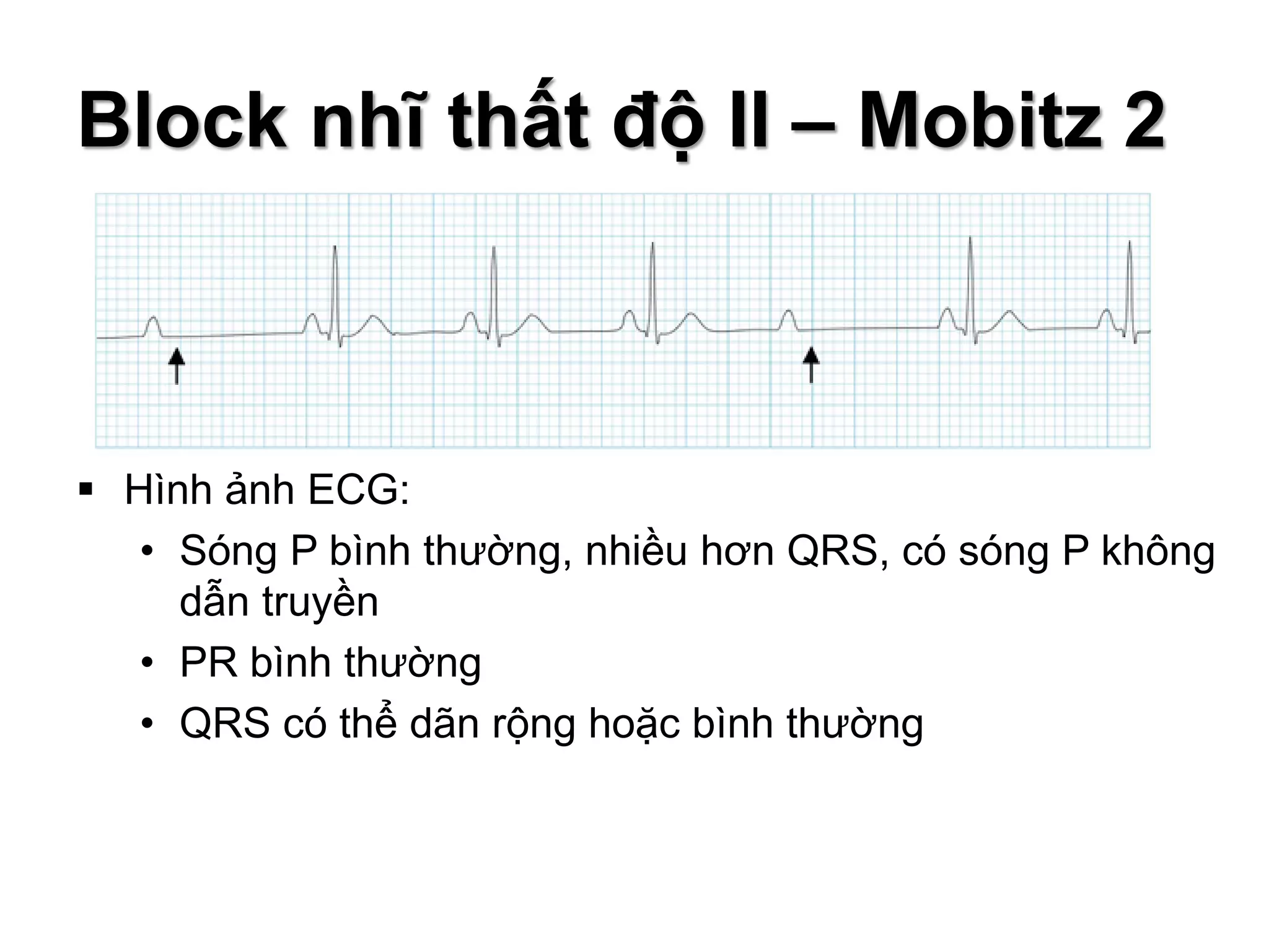 ECG BLOCK DẪN TRUYỀN | PDF