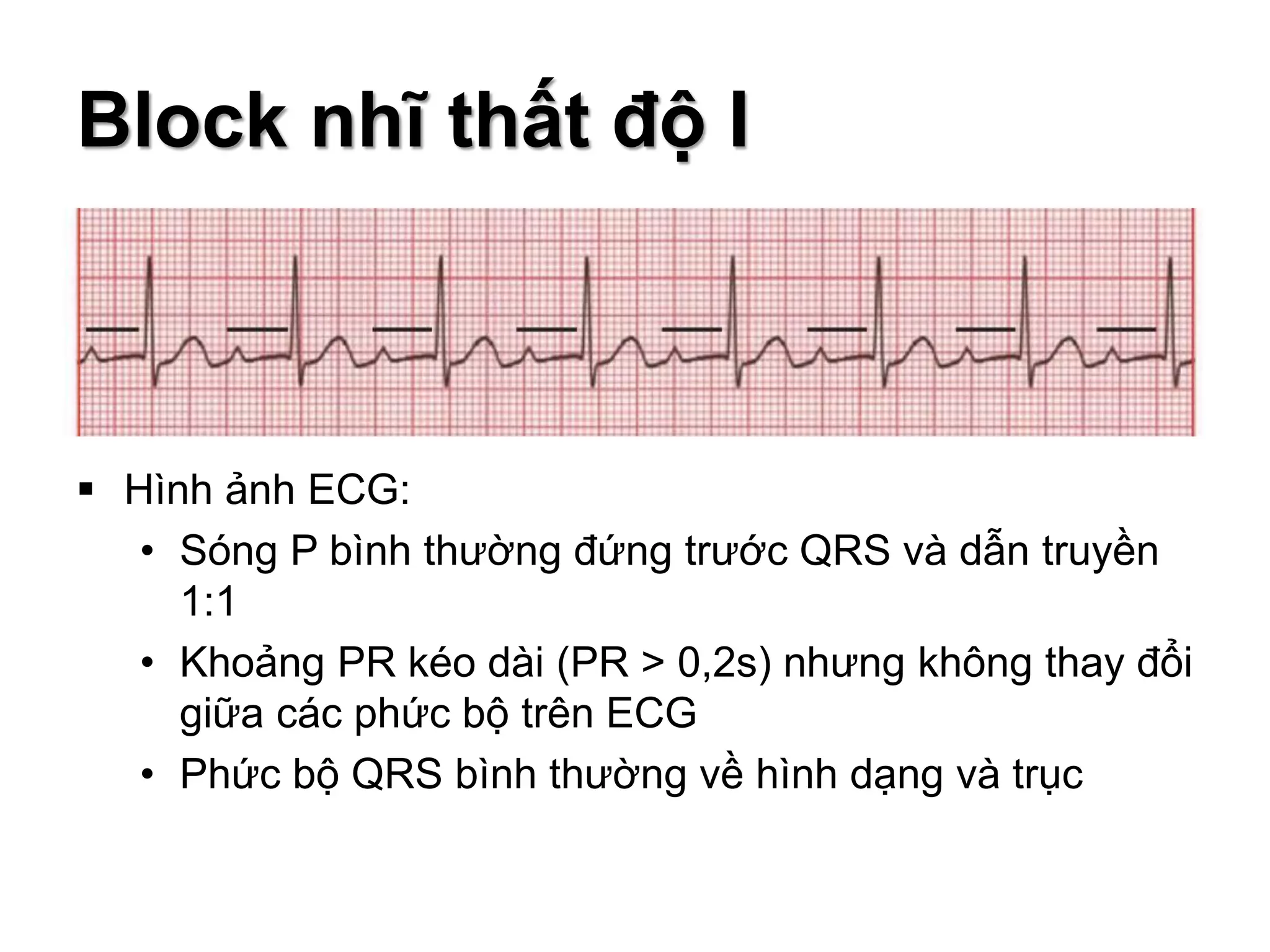 ECG BLOCK DẪN TRUYỀN | PDF
