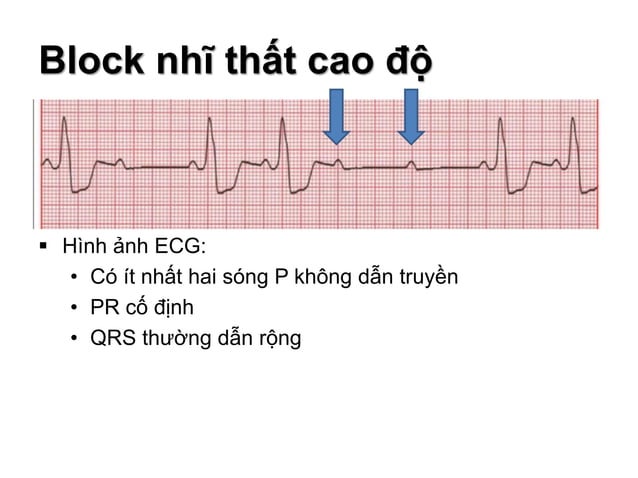 ECG BLOCK DẪN TRUYỀN | PDF