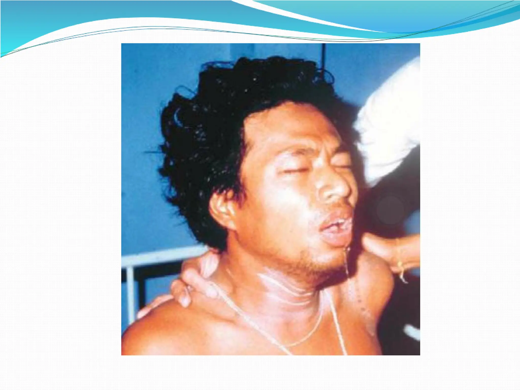 Cf Rabies Management Clinical Features Diagnosis Pptx