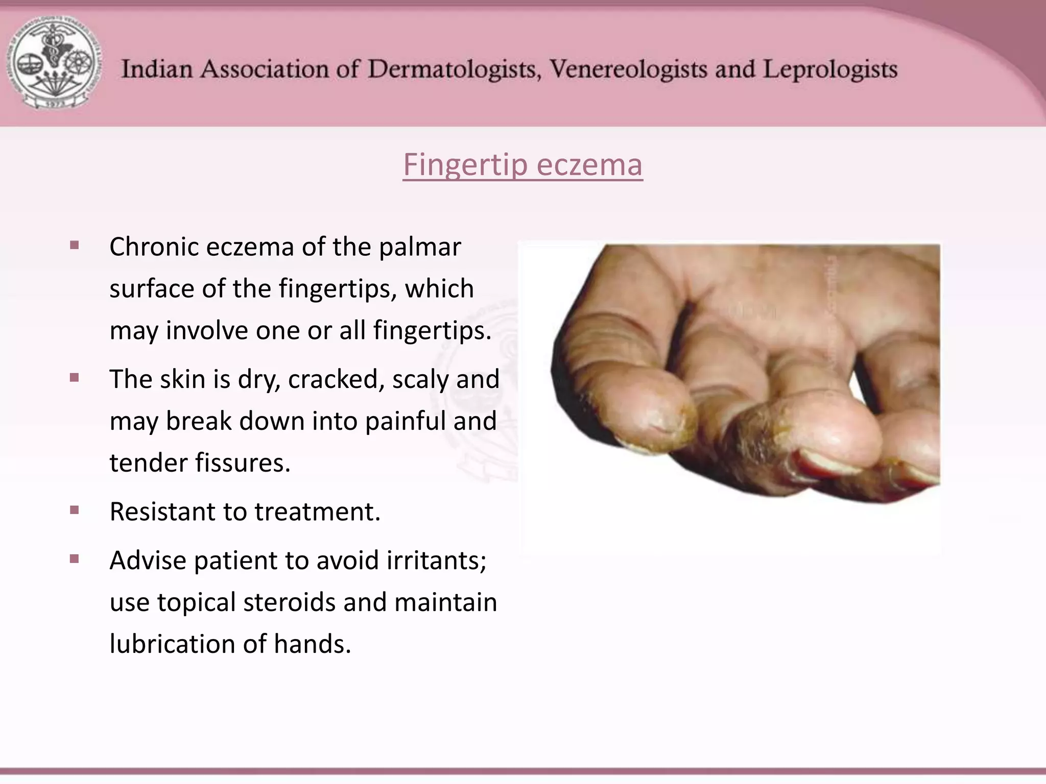 ECZEMA.ppt