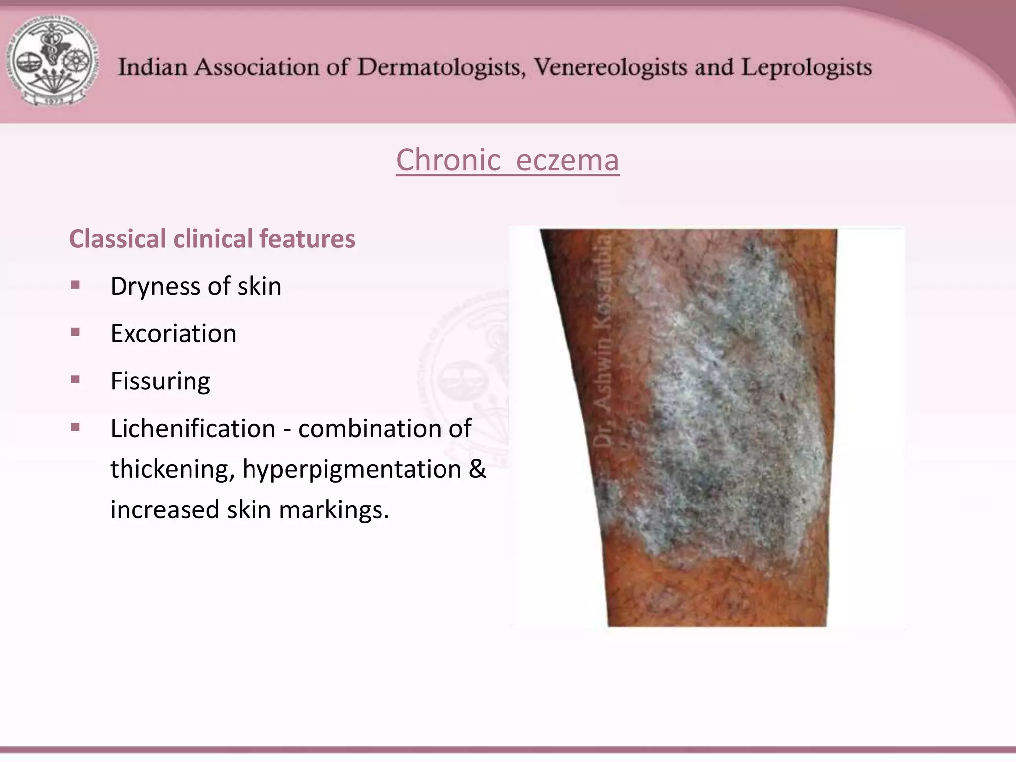 ECZEMA.ppt