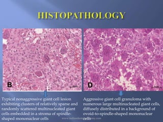 Central Giant Cell Granuloma Histology
