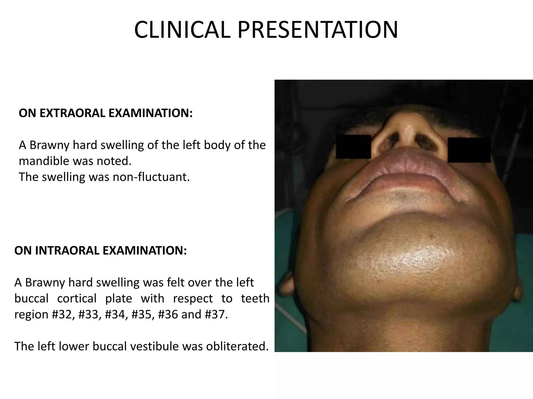 Central Giant Cell granuloma from Diagnosis to Management | PPTX