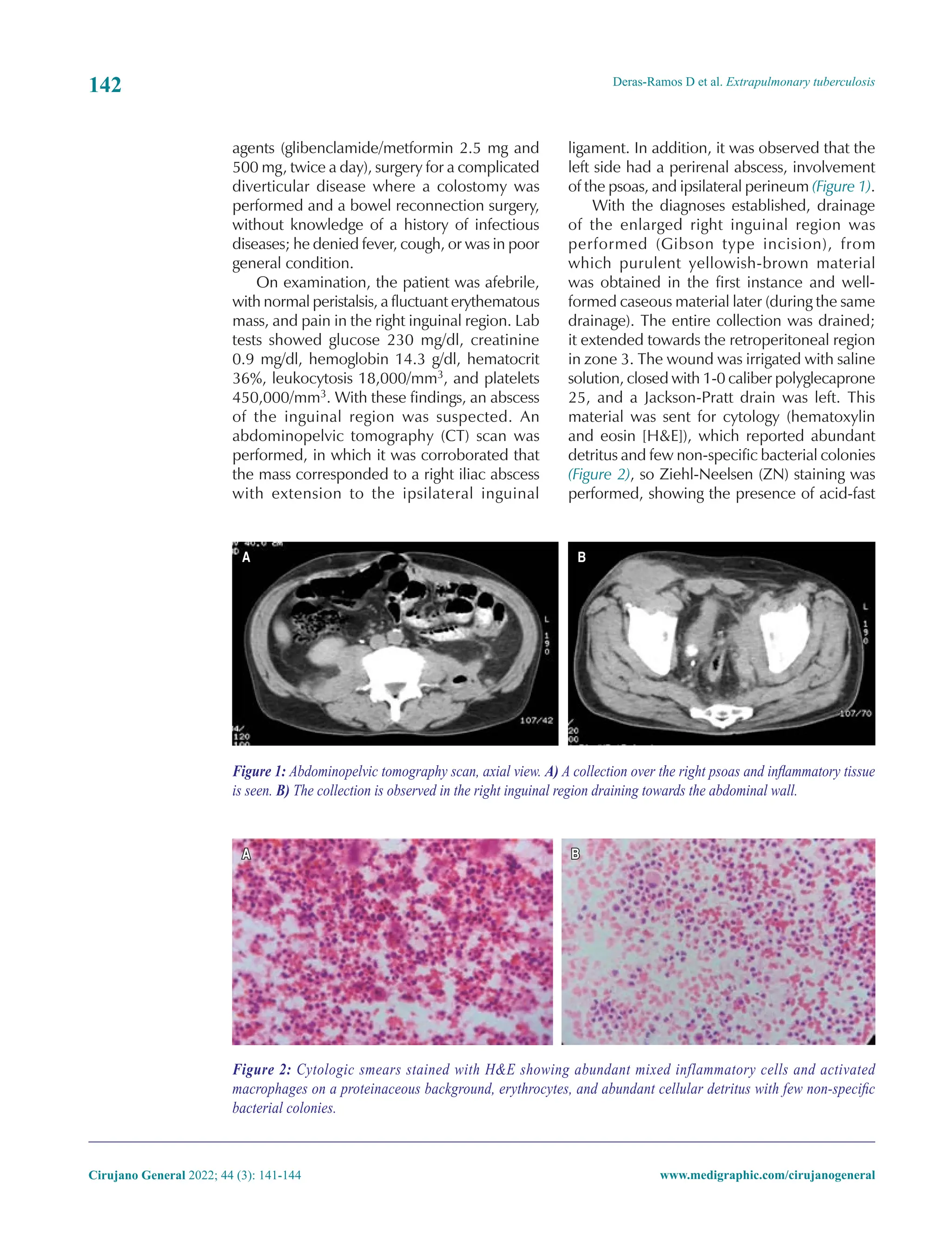 Extrapulmonary tuberculosis presents as a groin abscess | PDF