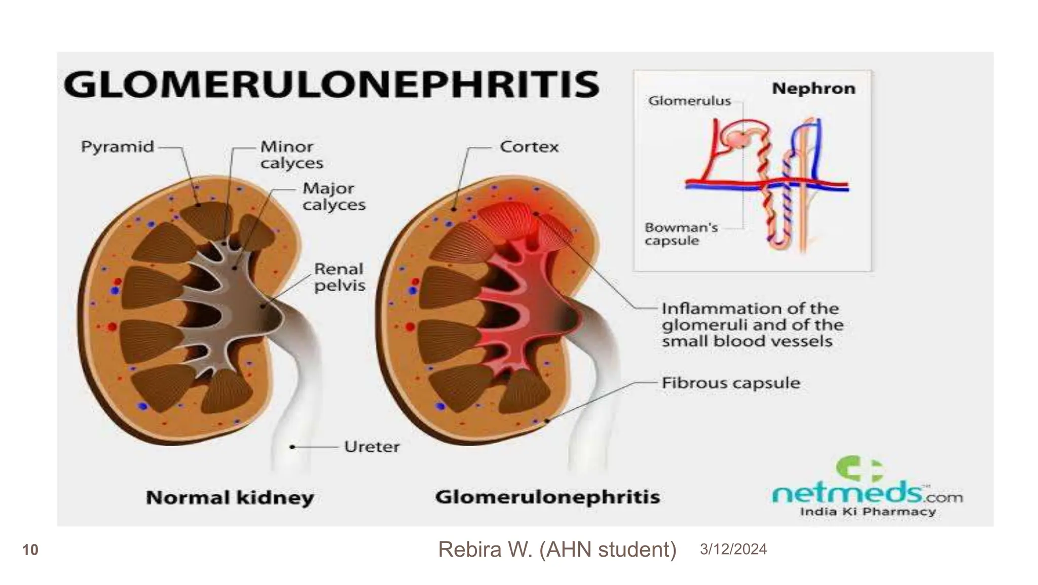Chronic Glomerulo Nephritis Presentation.pptx