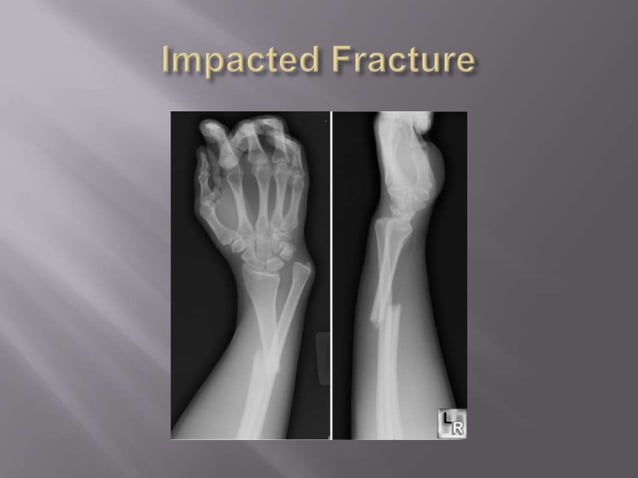 SP14 BIO120 CH4 Fractures | PPT