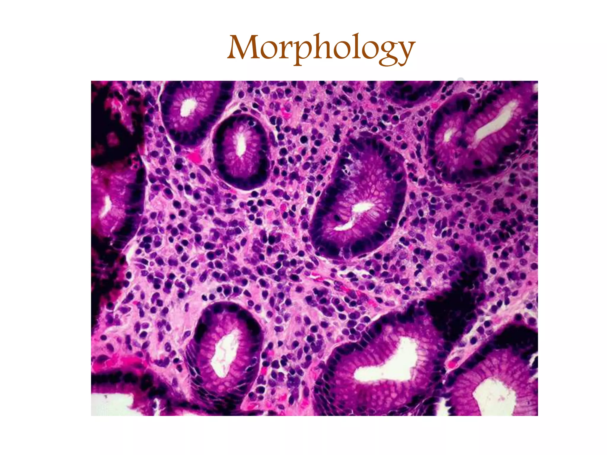 Chronic Gastritis Pathology | PPTX