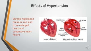 Chapter 2 High Blood Pressure | PPTX
