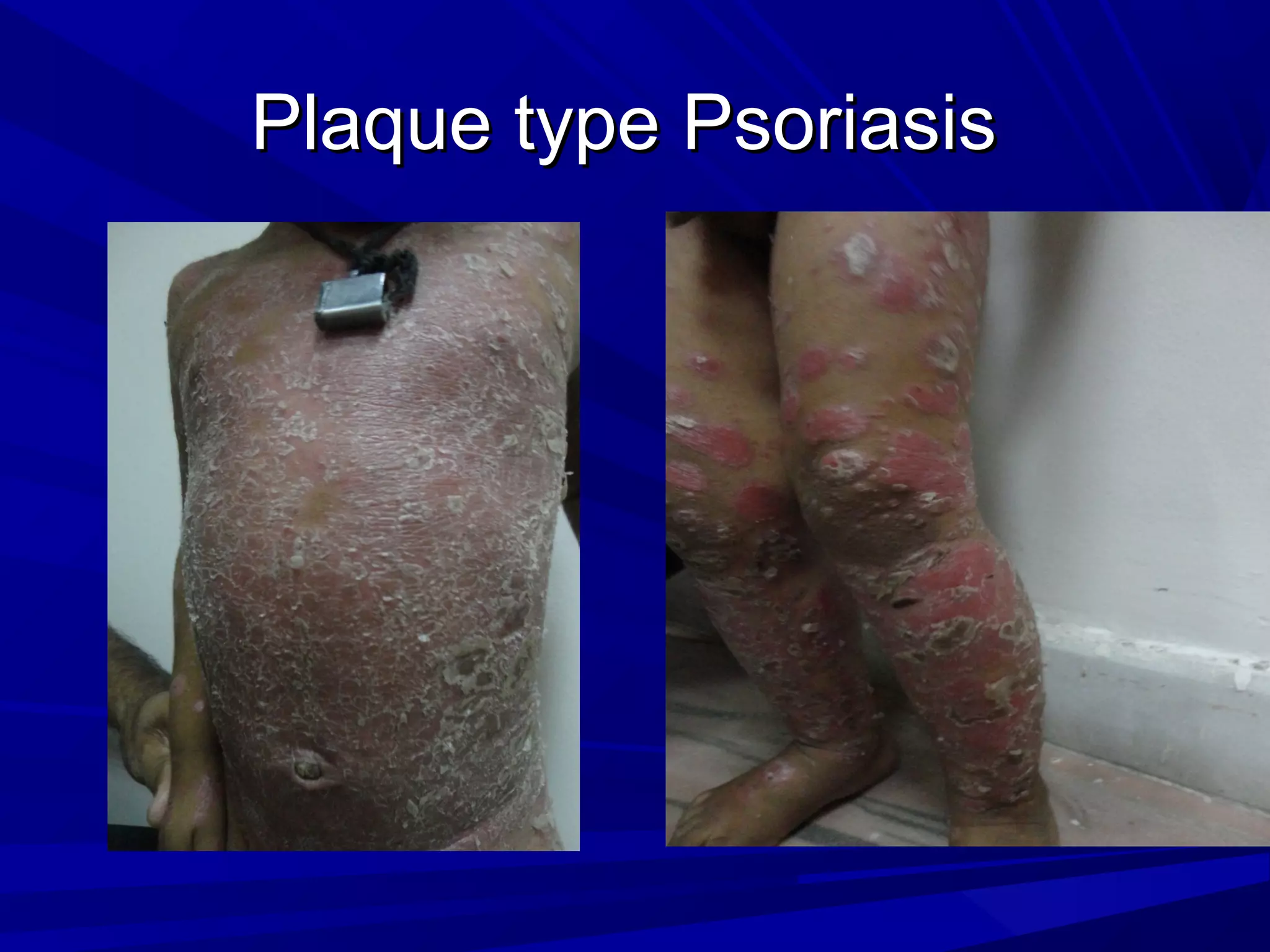 Pattern of childhood Psoriasis in Bangladesh | PPT | Skin and ...
