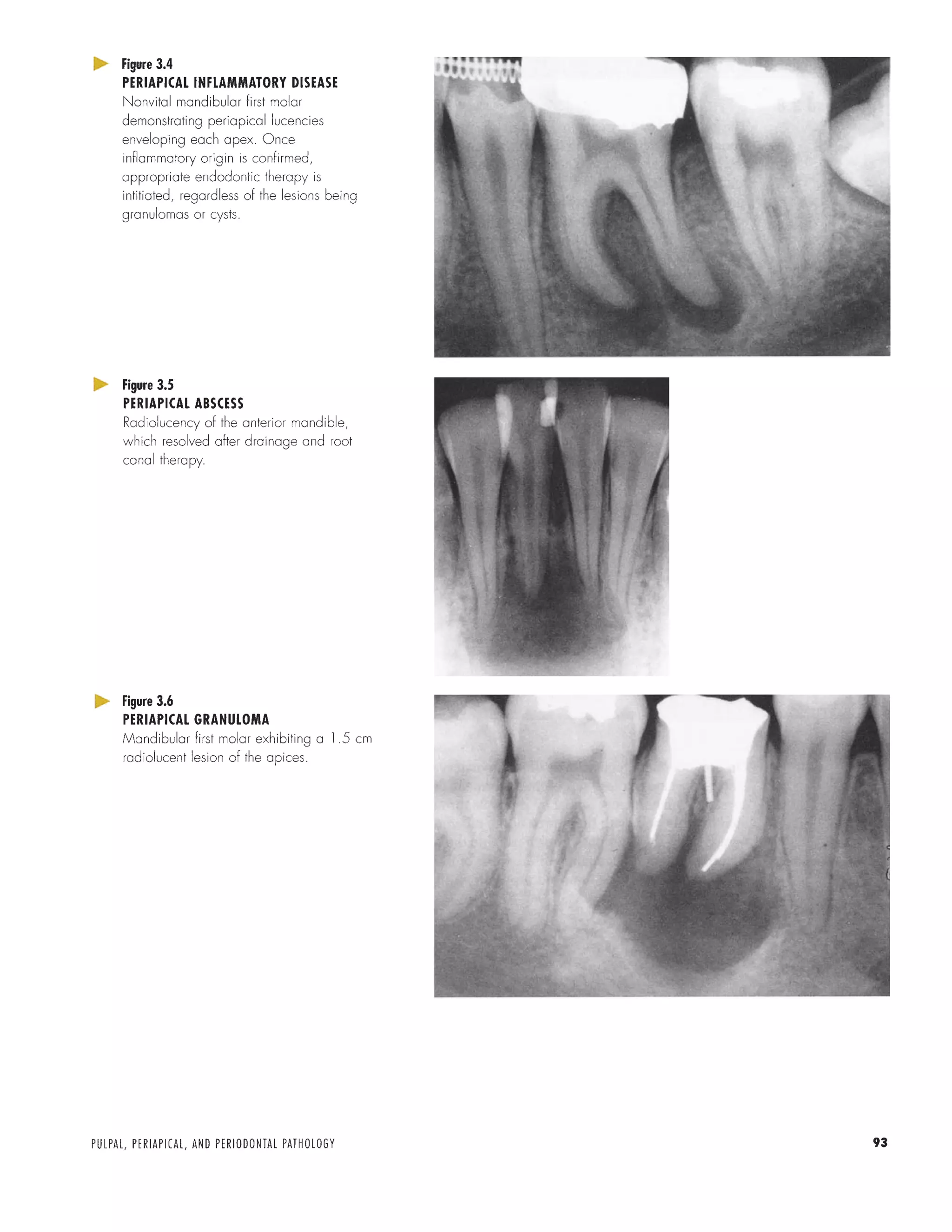 3/14 Oral Pathology Color Atlas- Pulpal, Periapical and Periodontal ...