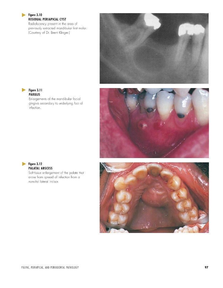 3/14 Oral Pathology Color Atlas- Pulpal, Periapical and Periodontal P…