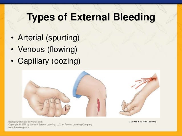 Ch08 presentation bleeding