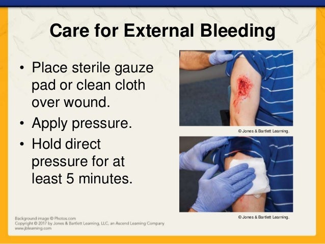 Ch08 presentation bleeding