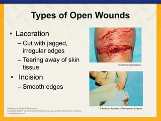 Ch09 presentation wounds | PPT