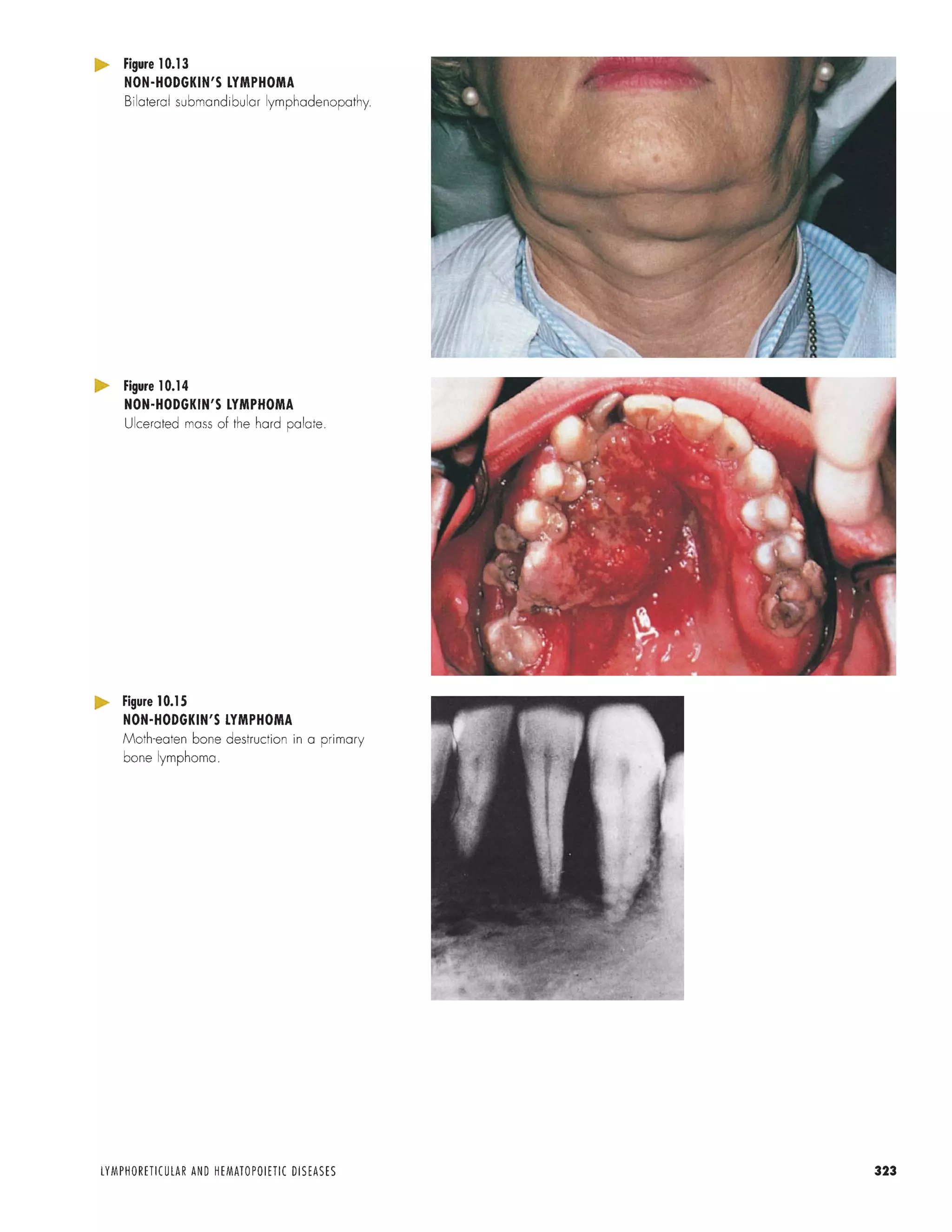 10/14 Lymphoreticular and Hematopoietic Diseases- OP Color Atlas | PDF