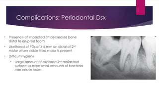 Principles of Management of Impacted Teeth_Mari-Alina_Timoshchuk.pptx