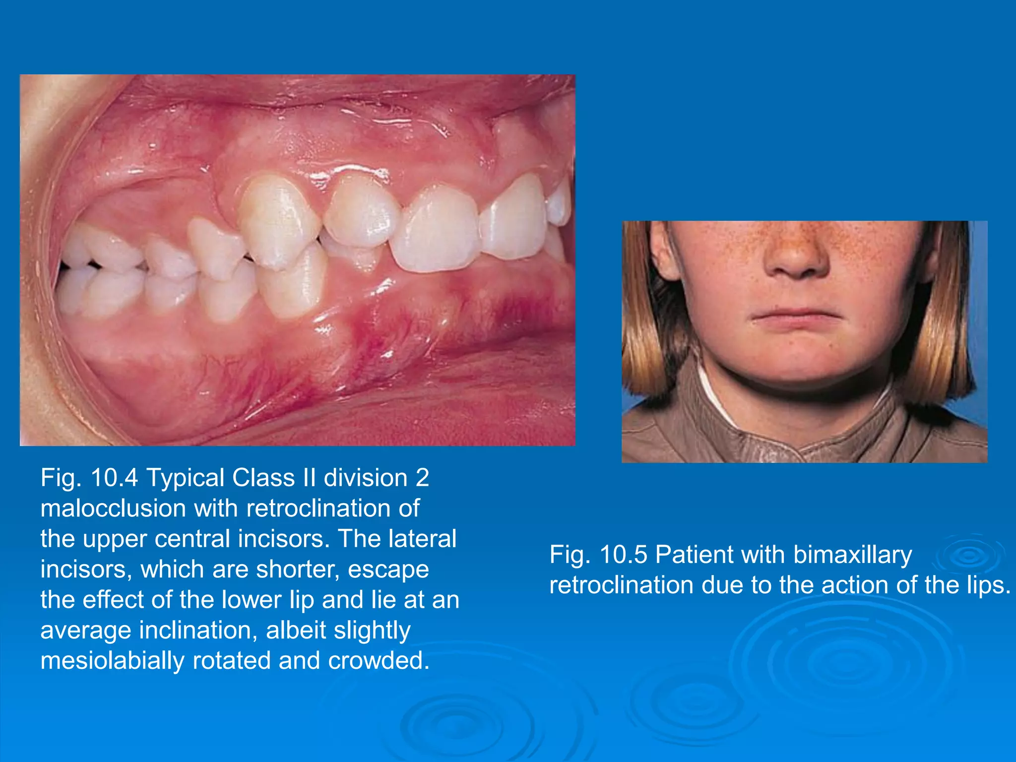 Orthodontics :Class II division 2 | PDF