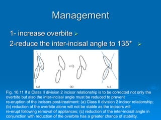 Orthodontics :Class II division 2 | PDF