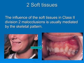 Orthodontics :Class II division 2 | PDF