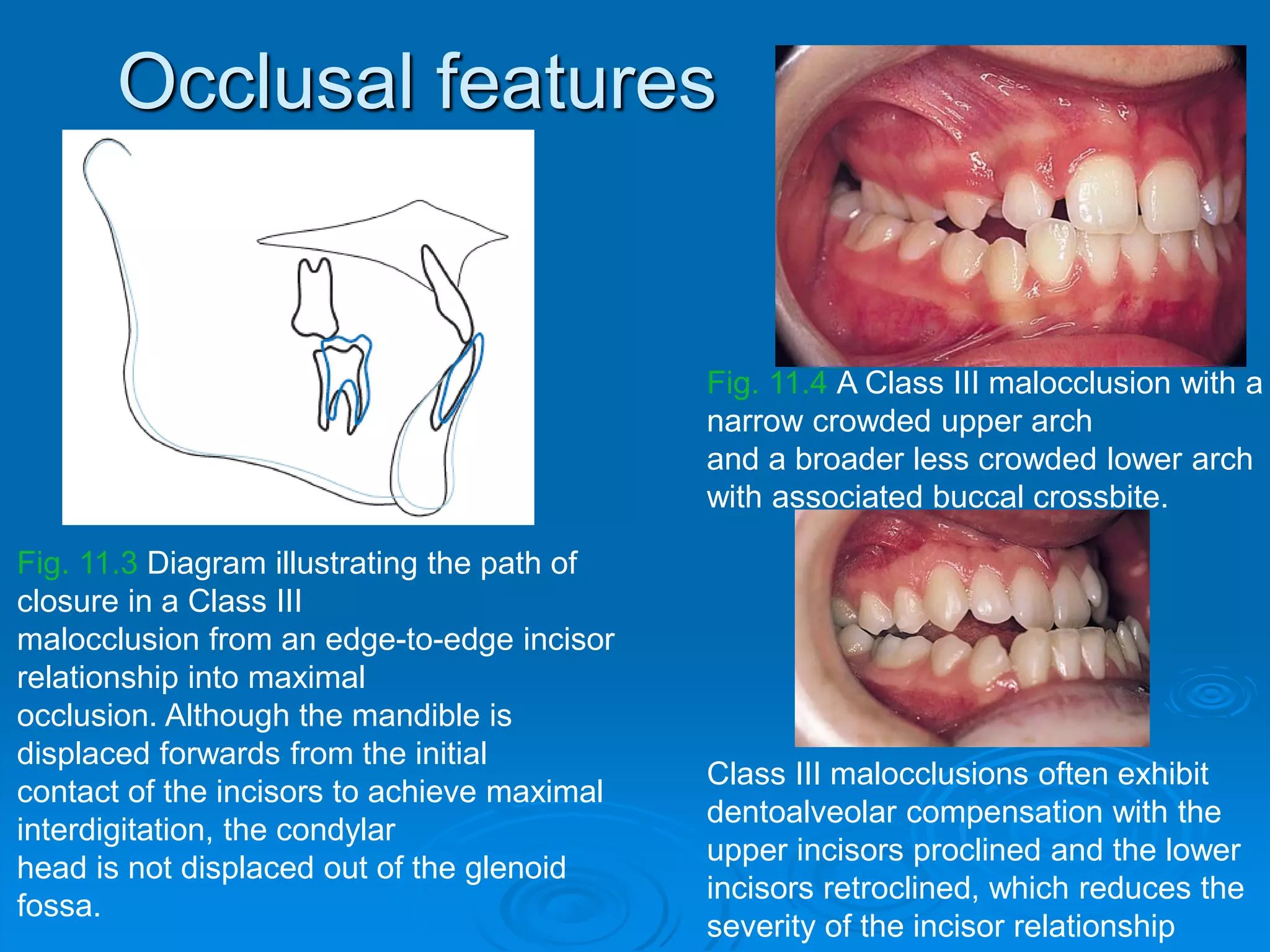 Class III Orthodontics Dentistry by Cezar E. | PDF
