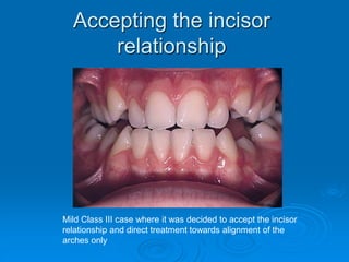 Class III Orthodontics Dentistry by Cezar E. | PDF
